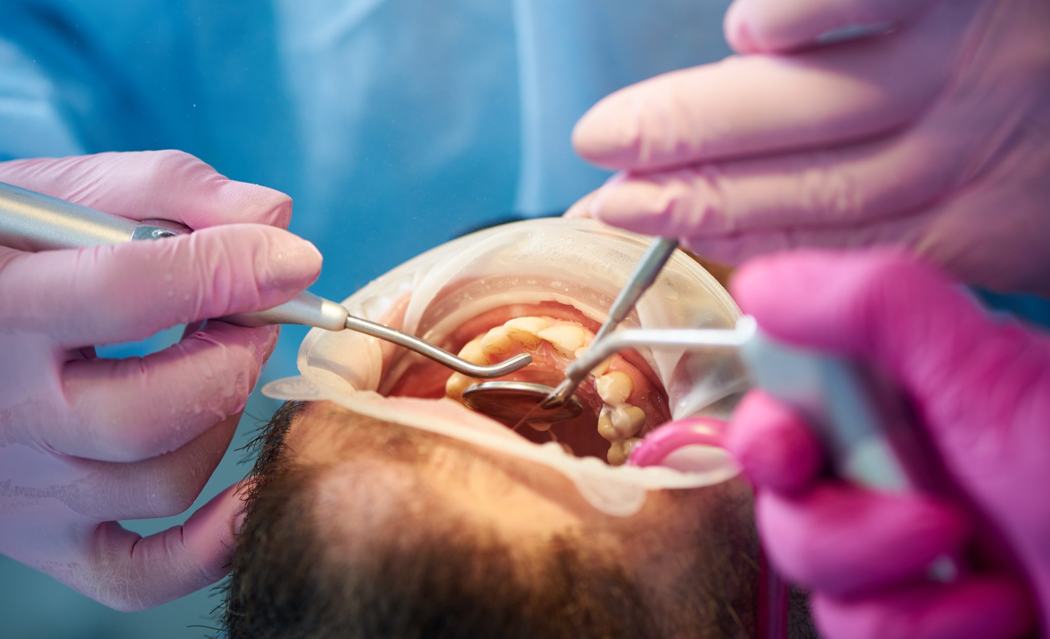 Everything You Need to Know About Tooth Extraction Procedure, Recovery ...